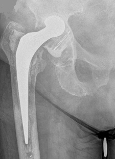 Editorial | Trabecular Metal Reconstruction in Revision Hip Surgery ...