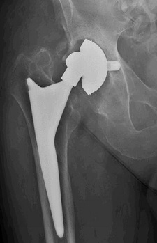 Editorial | Trabecular Metal Reconstruction in Revision Hip Surgery ...