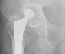 Editorial | Trabecular Metal Reconstruction in Revision Hip Surgery ...