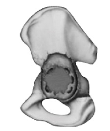 Editorial | Trabecular Metal Reconstruction in Revision Hip Surgery ...