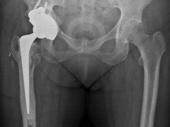 Reviews of the Stryker Exeter Hip