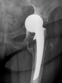 Reviews of the Stryker Exeter Hip