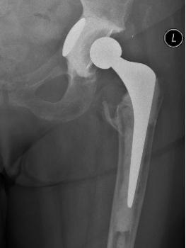 Reviews of the Stryker Exeter Hip