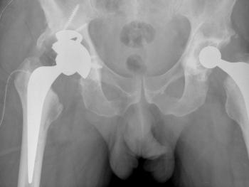 Reviews of the Stryker Exeter Hip