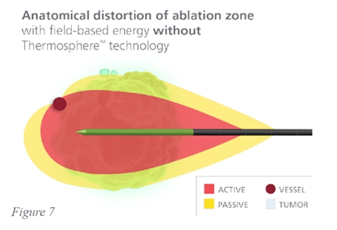 Reviews of the Medtronic Emprint HP Ablation System
