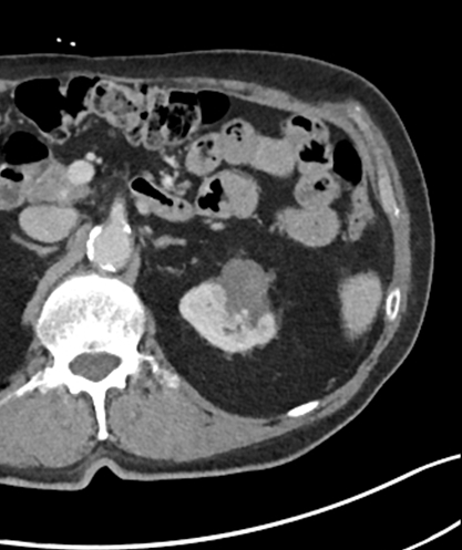 Reviews of the Medtronic Emprint HP Ablation System
