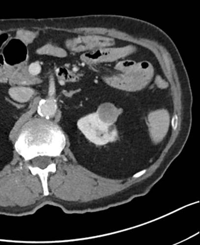Reviews of the Medtronic Emprint HP Ablation System