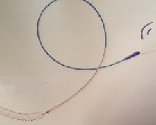 Medtronic | Abre venous self expanding stent system