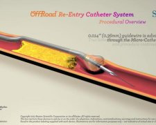 Boston Scientific | OffRoad Re-Entry Catheter System