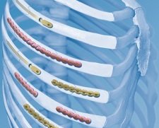 Depuy Synthes | MatrixRIB Fixation System