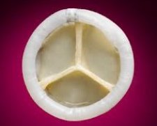 Direct Flow Medical | Direct Flow Medical Transcatheter Aortic Valve System