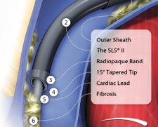 Spectranetics | SLS II Excimer Laser Sheath