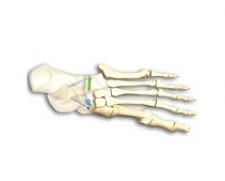 Extremity Medical | IO-Fix