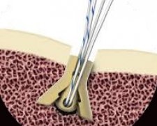 Medshape | Morphix Suture Anchor System