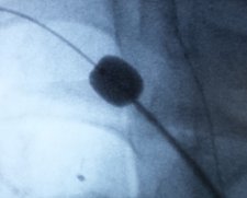 Balt Extrusion | Corail Plus Occlusion Balloon