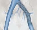 Abbott Vascular | Absolute Pro LL Peripheral Stent System